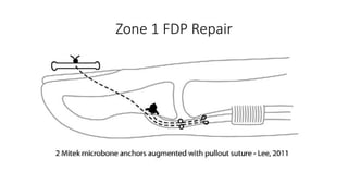 Hand flexor tendon repair basics 40 characters | PPT