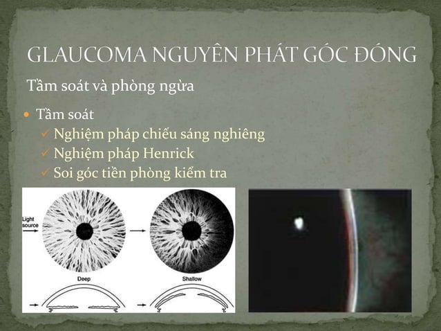 BỆNH GLAUCOMA | PPTX