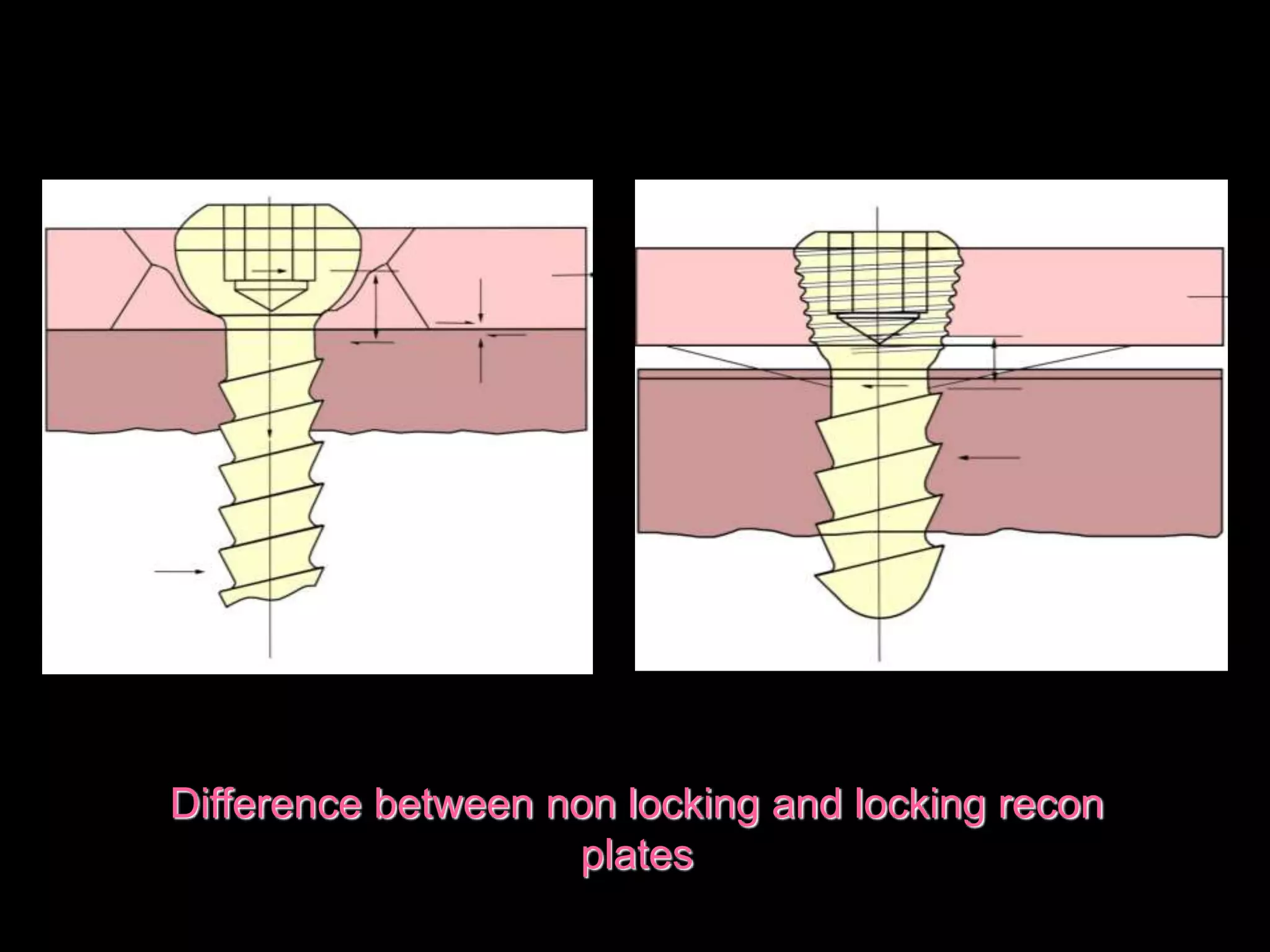 osteosynthesis materials and systems | PPTX