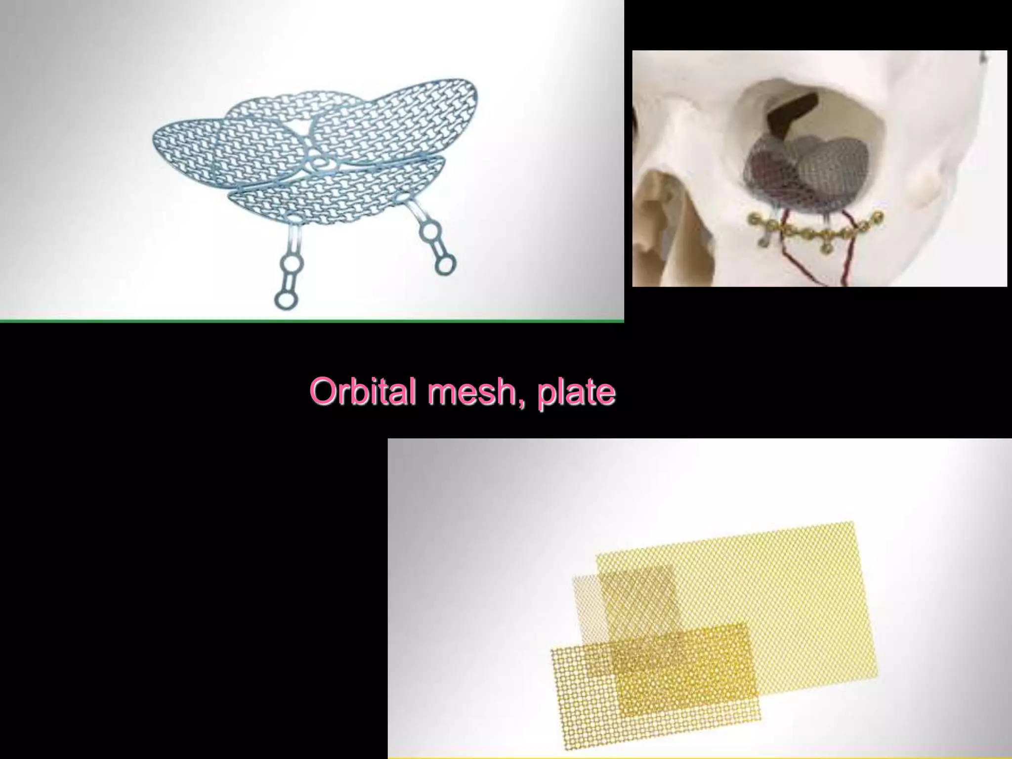 osteosynthesis materials and systems | PPTX