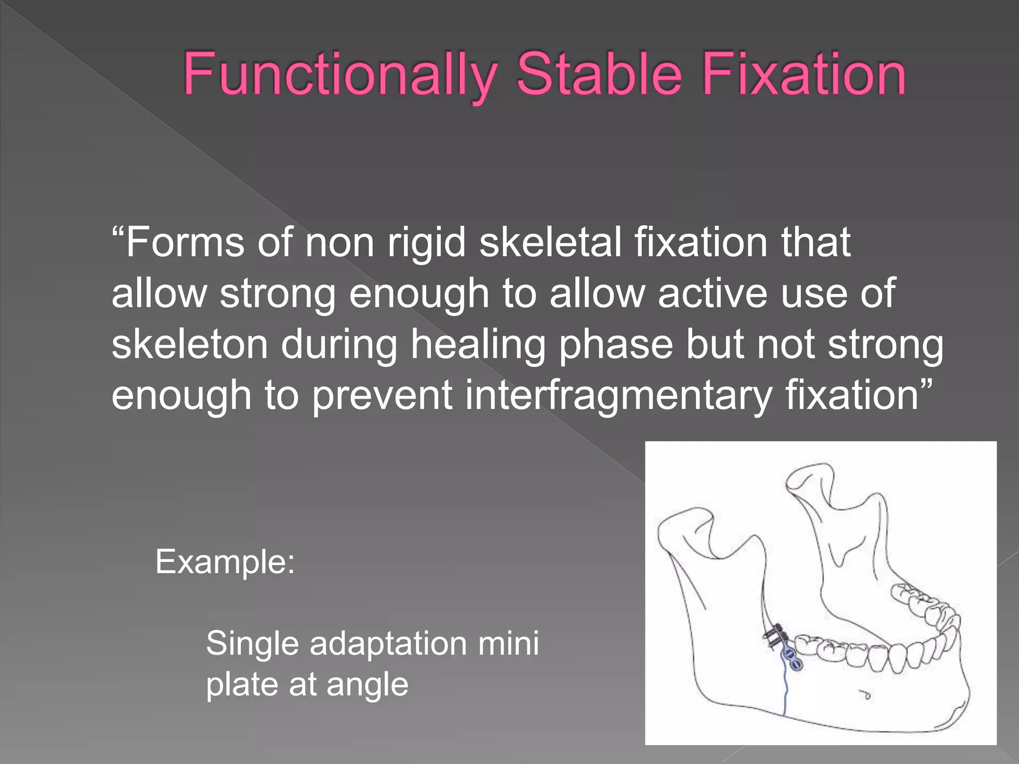 osteosynthesis materials and systems | PPTX