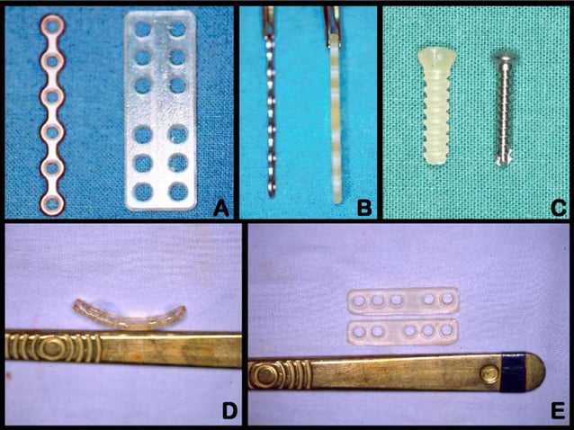 osteosynthesis materials and systems | PPTX | Bone and Joint Conditions ...