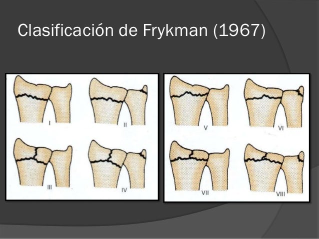Fractura de Muñeca