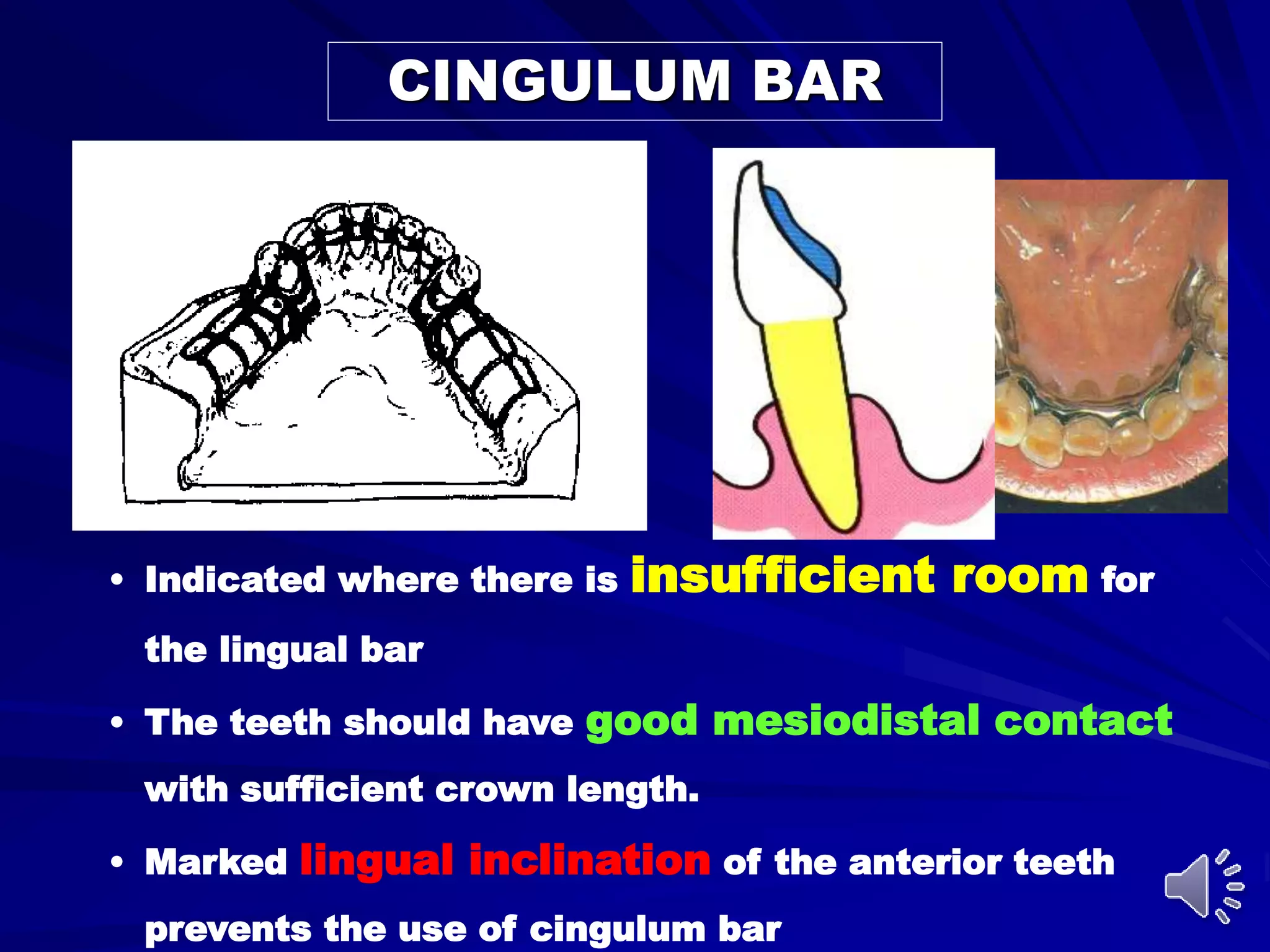 Mandibular major connectors and minor connectors | PPT
