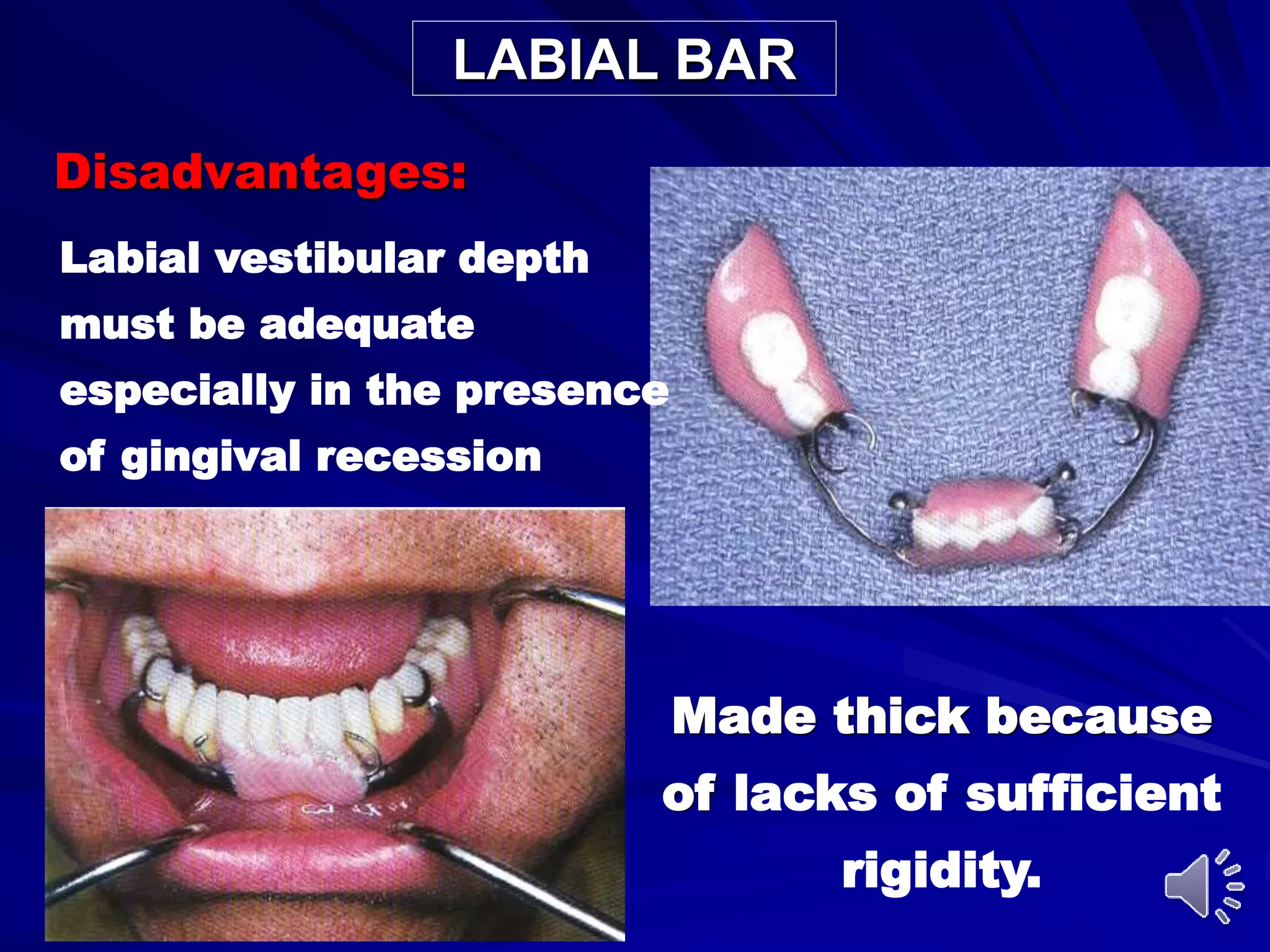 Mandibular major connectors and minor connectors | PPT