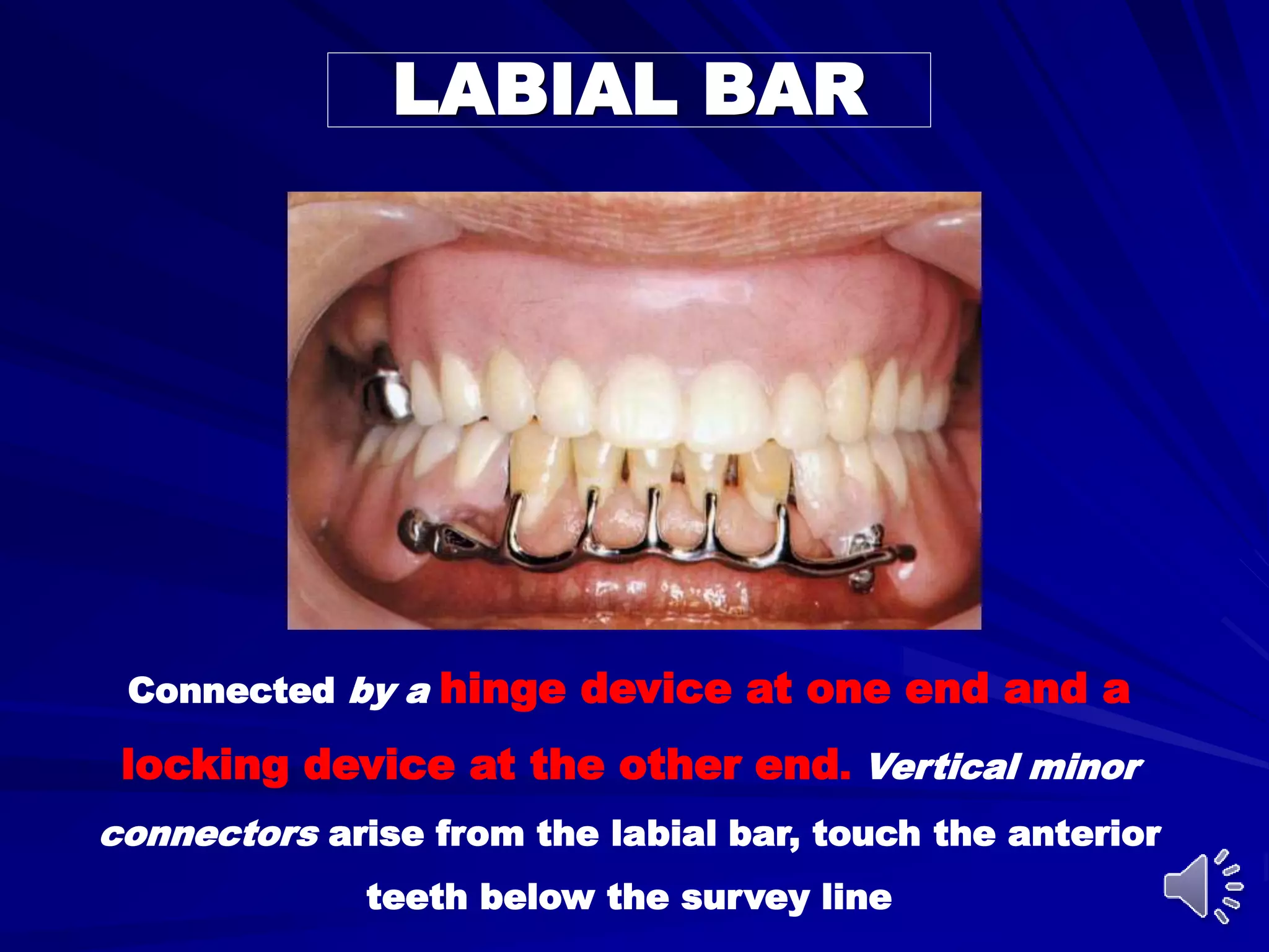 Mandibular major connectors and minor connectors | PPT