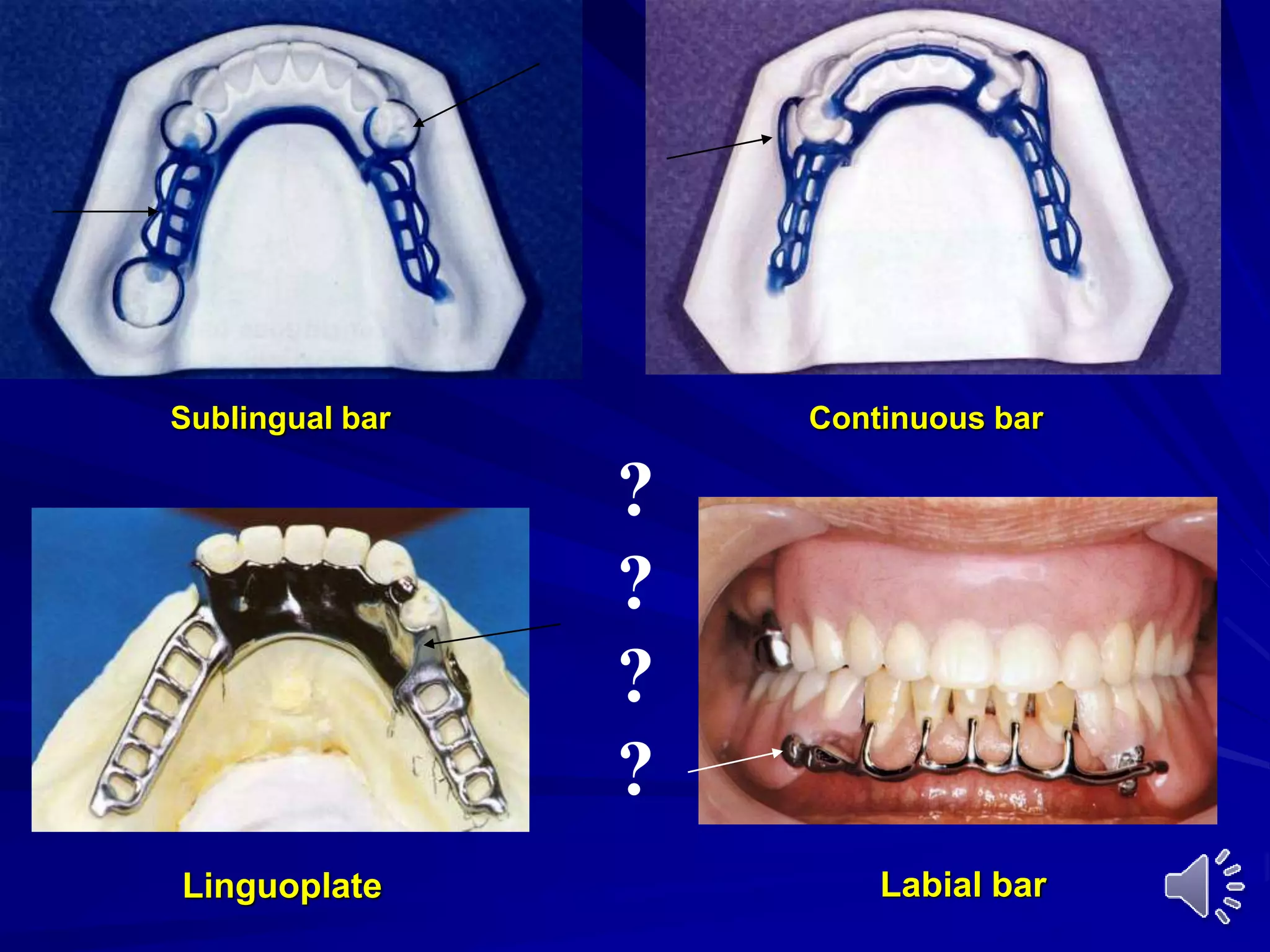 Mandibular major connectors and minor connectors | PPT
