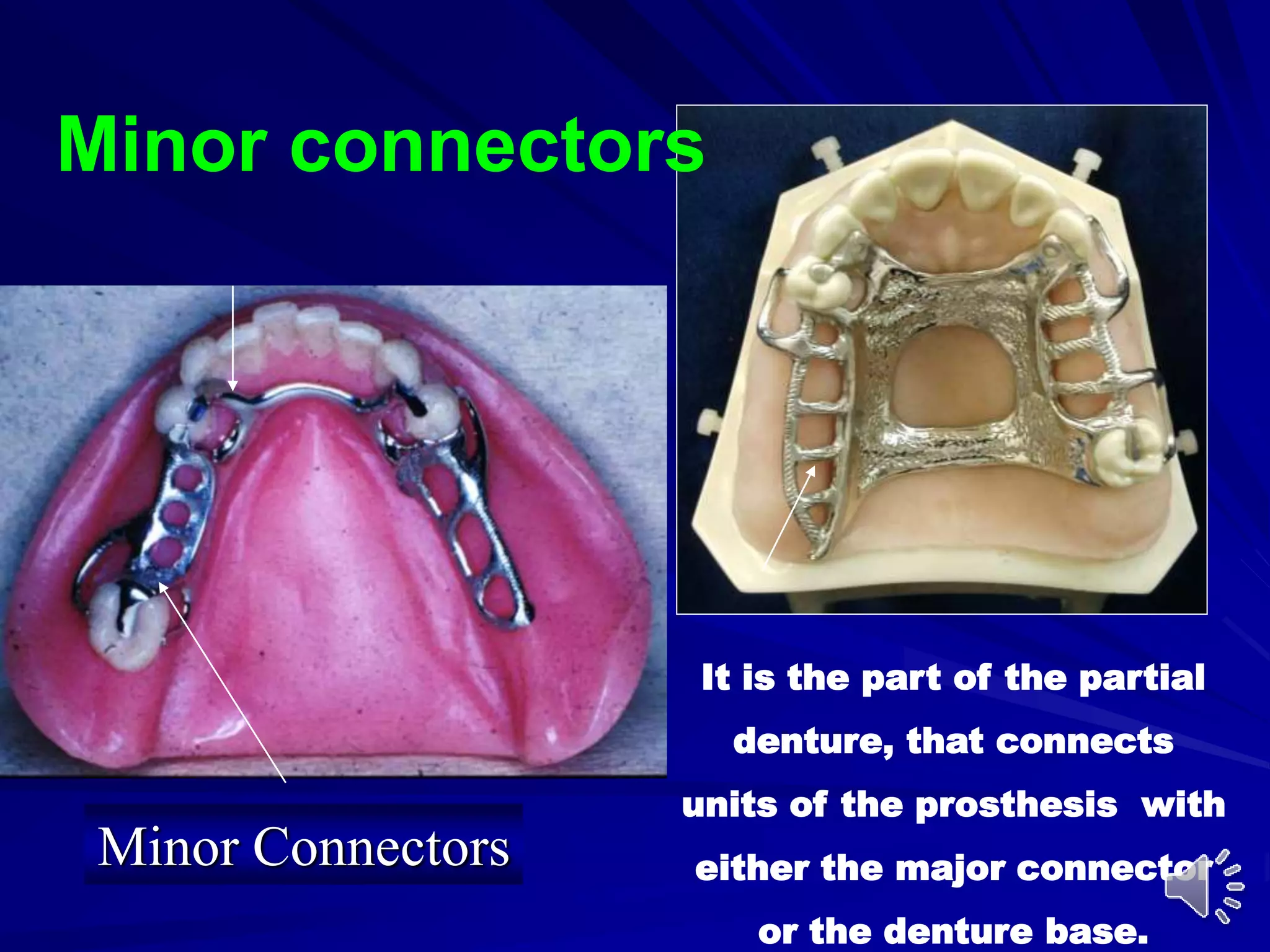 Mandibular major connectors and minor connectors | PPT