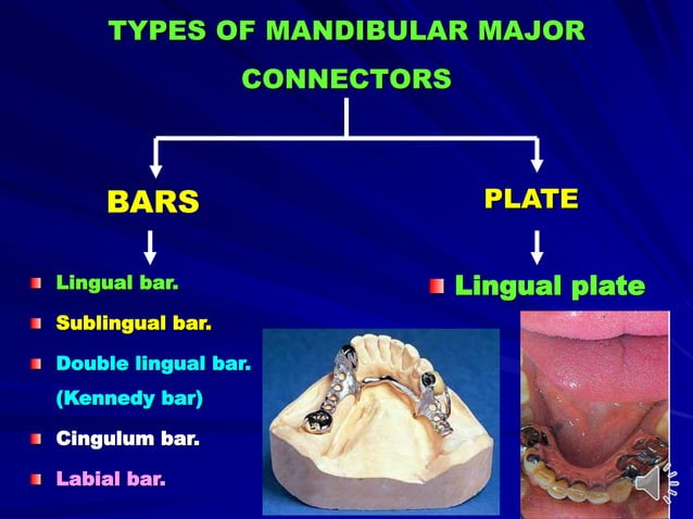 Mandibular major connectors and minor connectors | PPT | Oral care ...