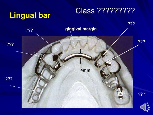Mandibular major connectors and minor connectors | PPT | Oral care ...
