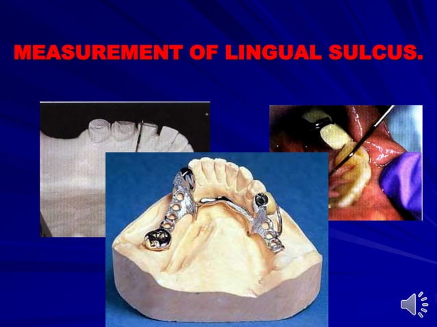 Mandibular major connectors and minor connectors | PPT | Oral care ...