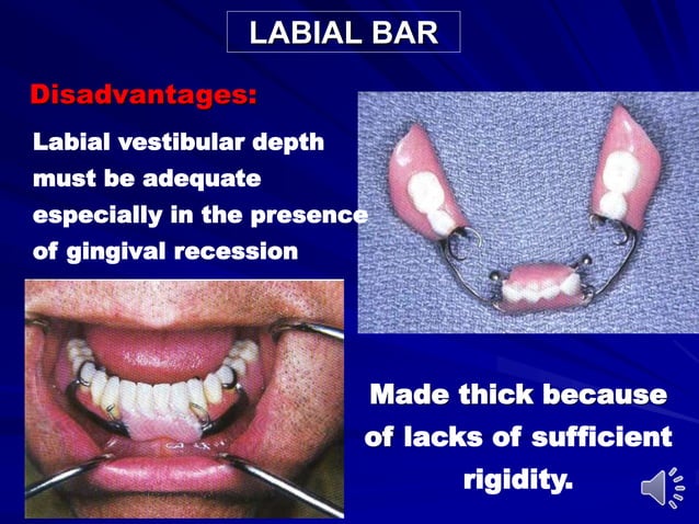 Mandibular major connectors and minor connectors | PPT | Oral care ...