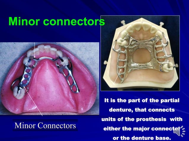 Mandibular major connectors and minor connectors | PPT | Oral care ...