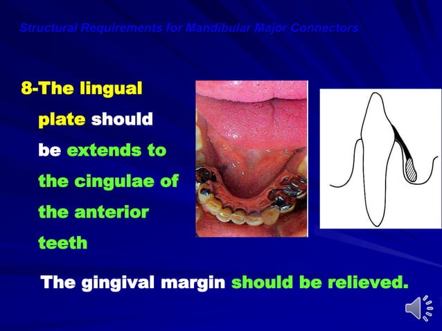 Mandibular major connectors and minor connectors | PPT | Oral care ...