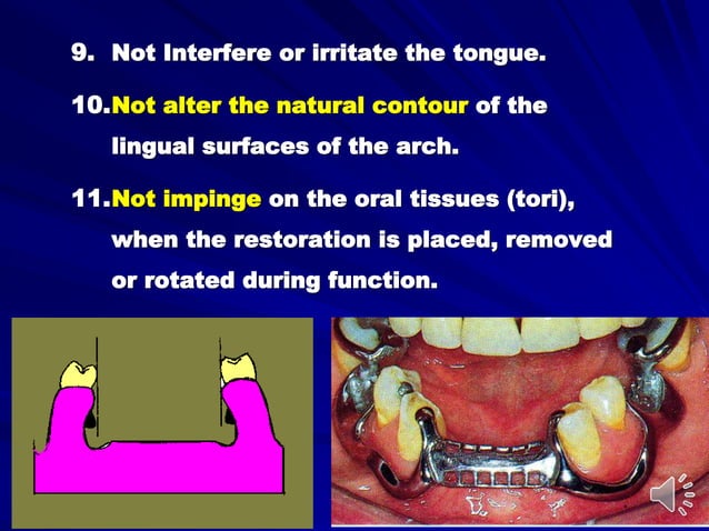 Mandibular major connectors and minor connectors