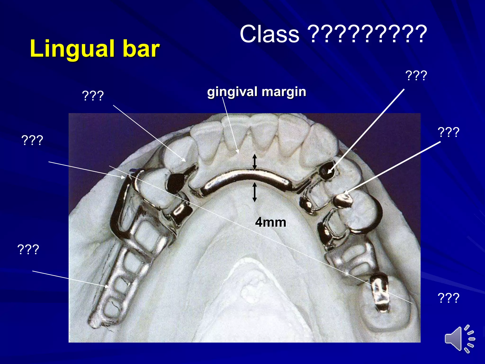 Mandibular major and minor connectors of RPDs | PPT