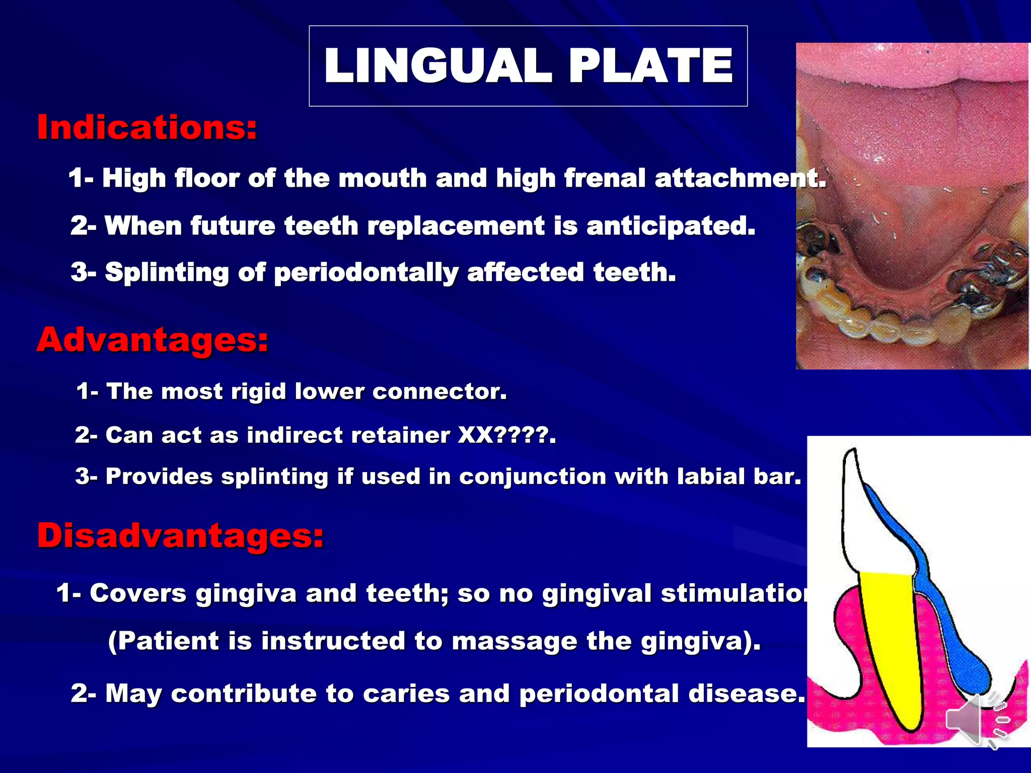 Mandibular major and minor connectors of RPDs | PPT