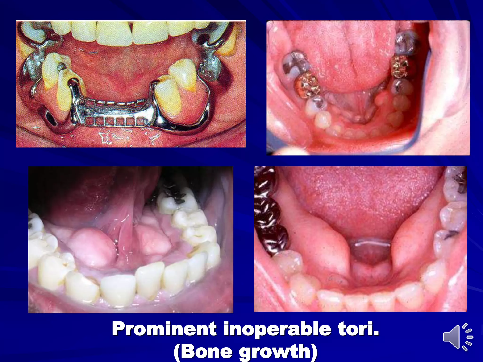 Mandibular major and minor connectors of RPDs | PPT