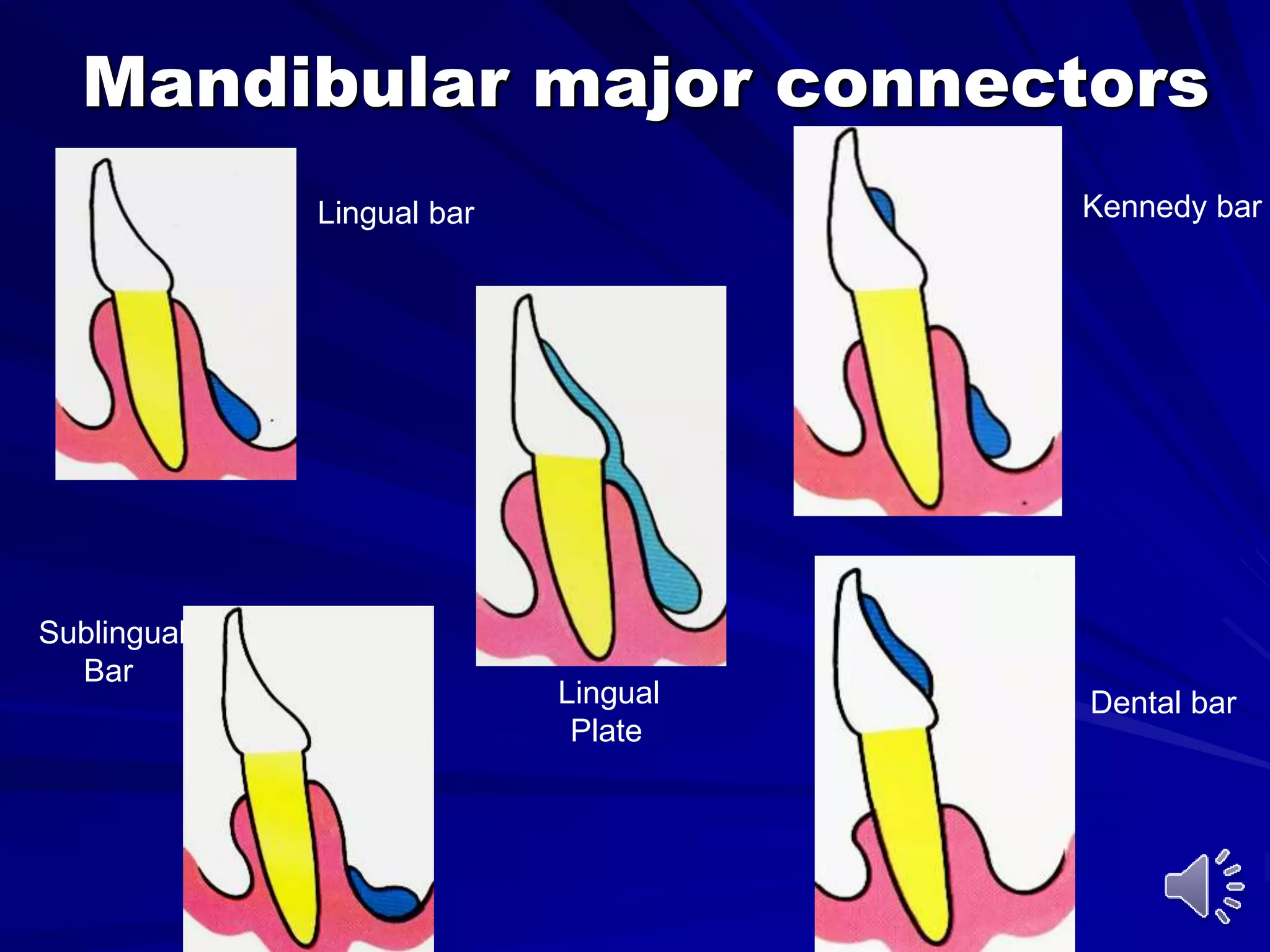Mandibular major and minor connectors of RPDs | PPT