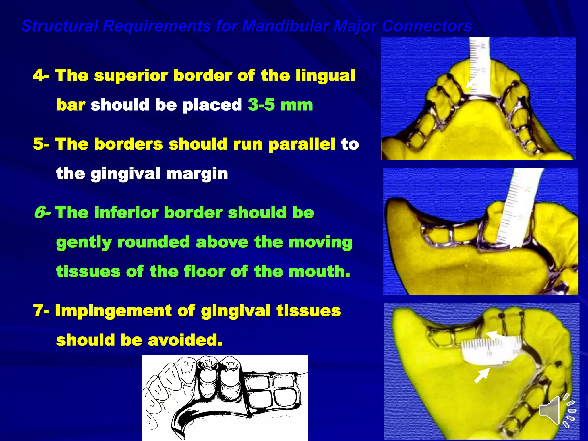 Mandibular major and minor connectors of RPDs | PPT