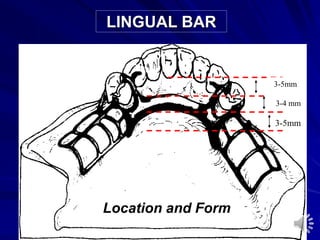 Mandibular major and minor connectors of RPDs | PPT