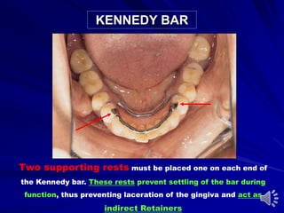 Mandibular major and minor connectors of RPDs | PPT
