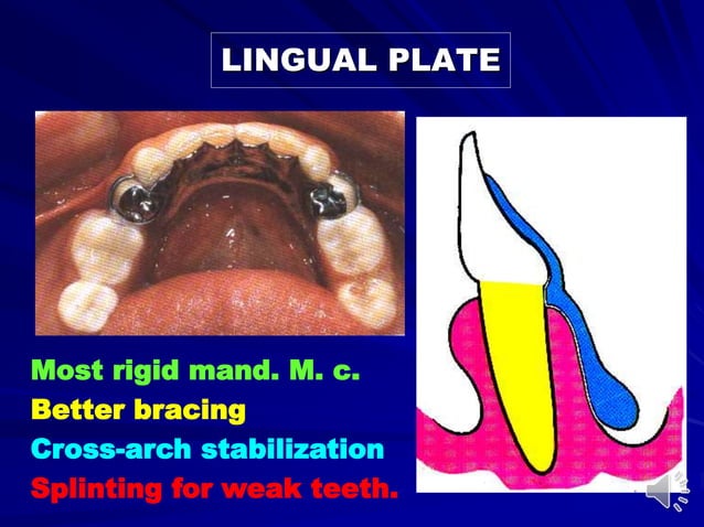 Mandibular major and minor connectors of RPDs | PPT