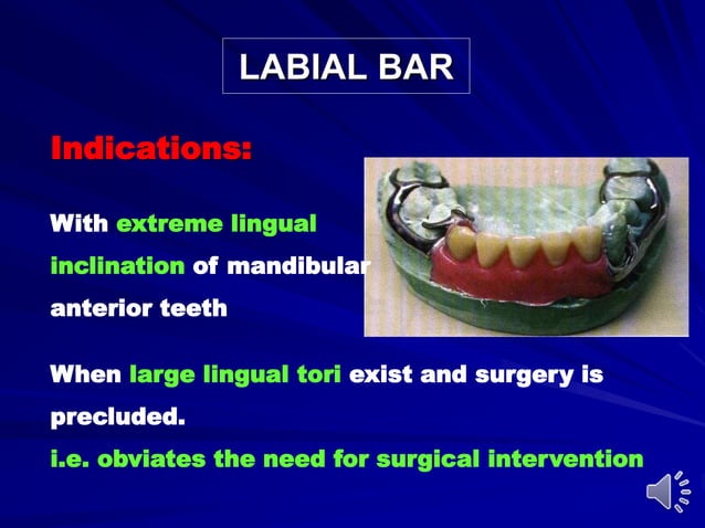 Mandibular major and minor connectors of RPDs | PPT