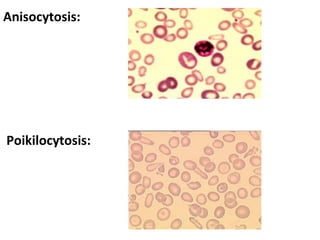 Anisocytosis Rbc