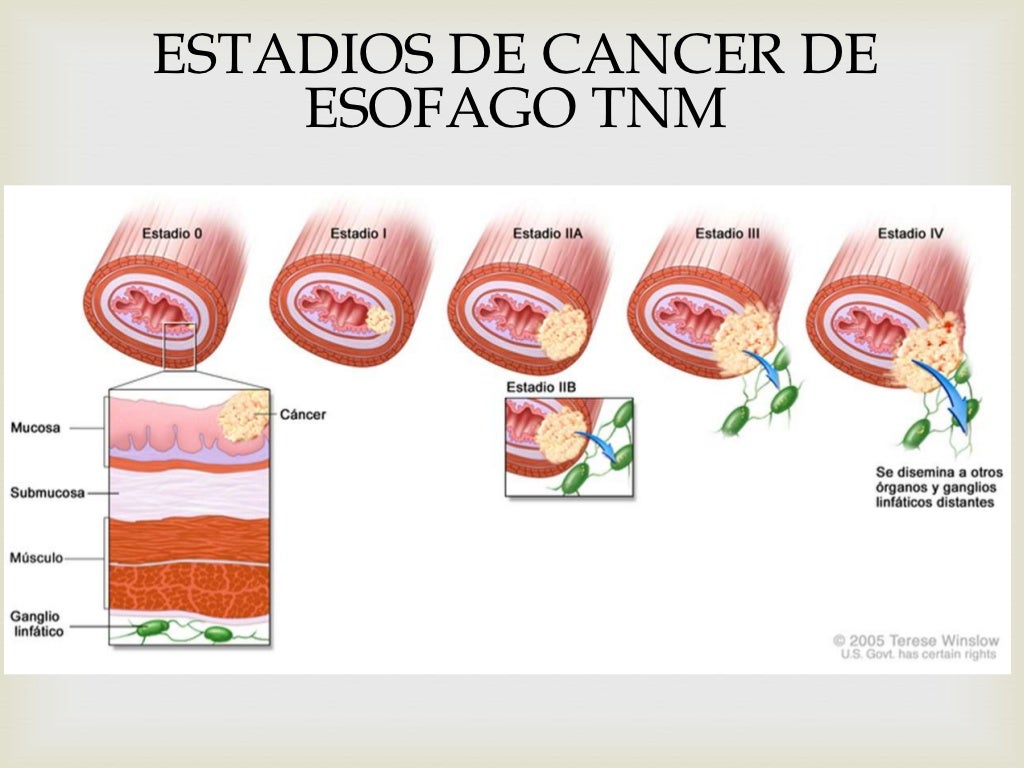 Cancer De Esofago Que Es Causas Tipos Tratamiento Y Mas Images