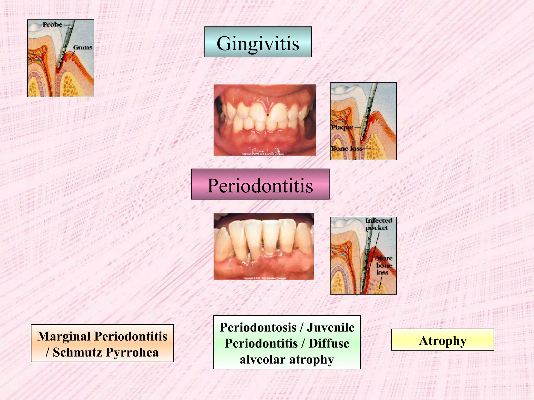 Epidemiology of periodontal diseases | PPT