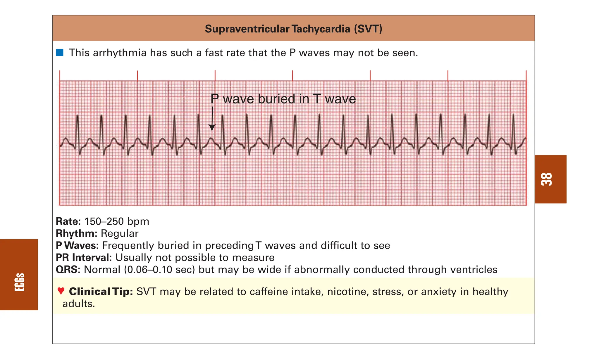 0803613474 - ECG Notes Interpretation And Management Guide.pdf