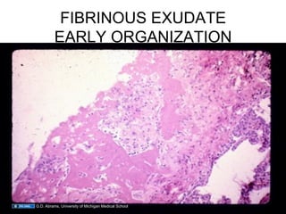 08.21.08: Inflammation and Repair IV | PPT