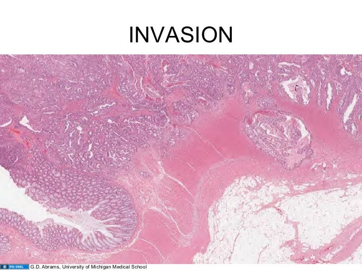 08.25.08: Neoplasia II