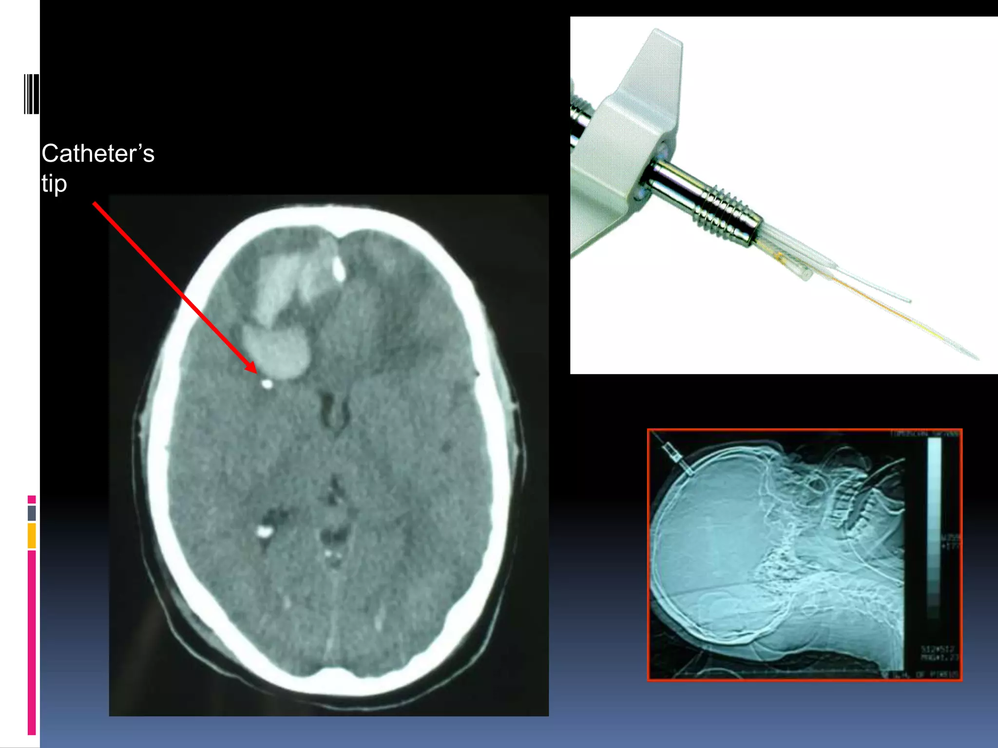 Brain monitoring using intraparenchymal cathters | PPTX