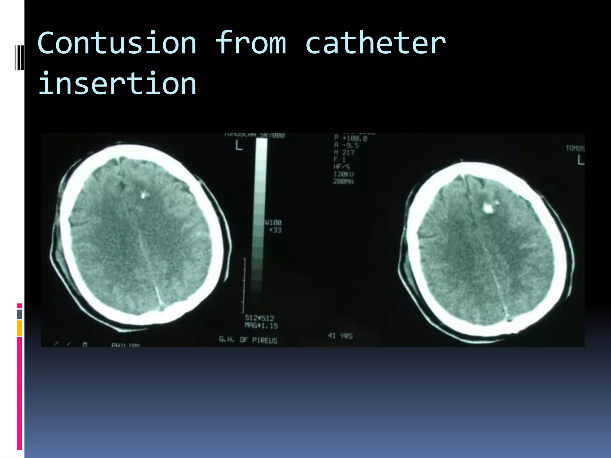Brain monitoring using intraparenchymal cathters | PPTX
