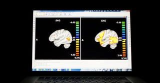 Brain scan of a child on the autism spectrum | Curtis Cripe | PDF