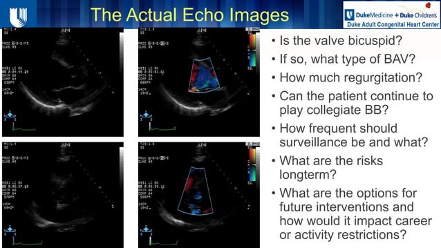 Bicuspid Aortic Valve in Athletes - Duke SCD.24