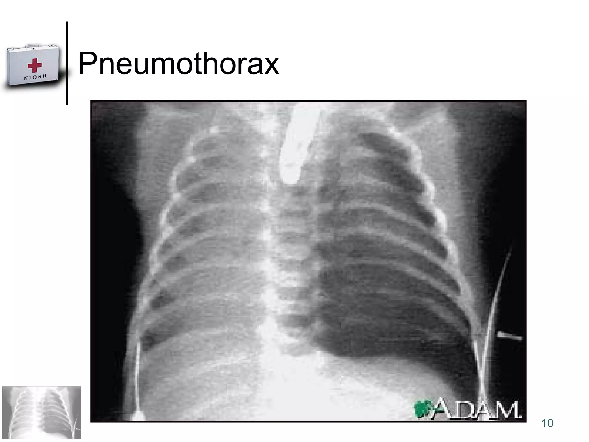 First Aid For Chest Injury | PPT