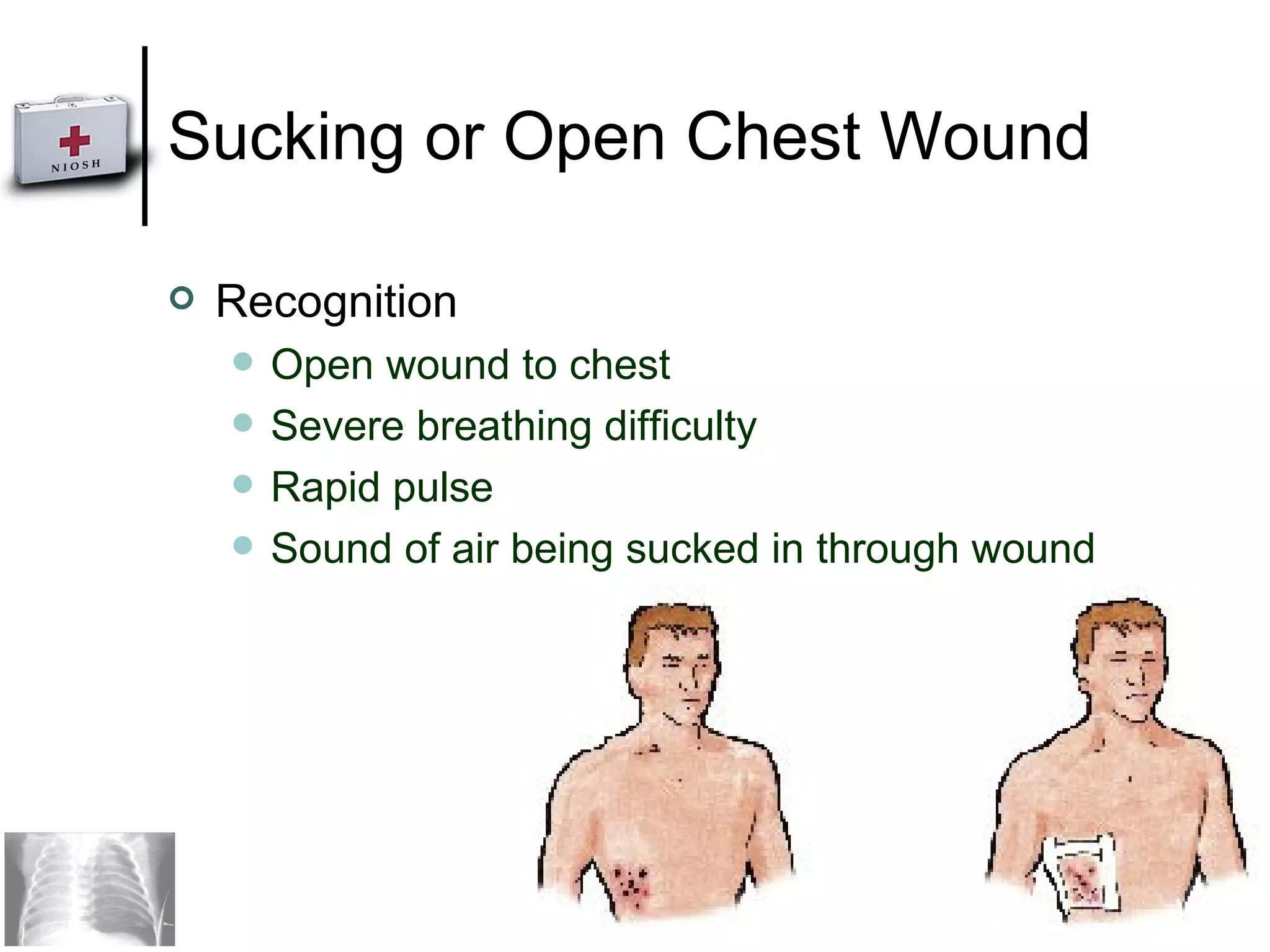 First Aid For Chest Injury | PPT