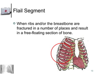 First Aid For Chest Injury | PPT