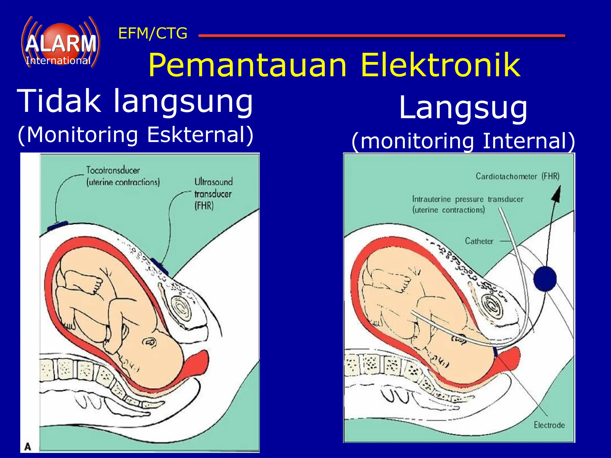 Electronic Fetal Monitoring (EFM-CTG).pptx