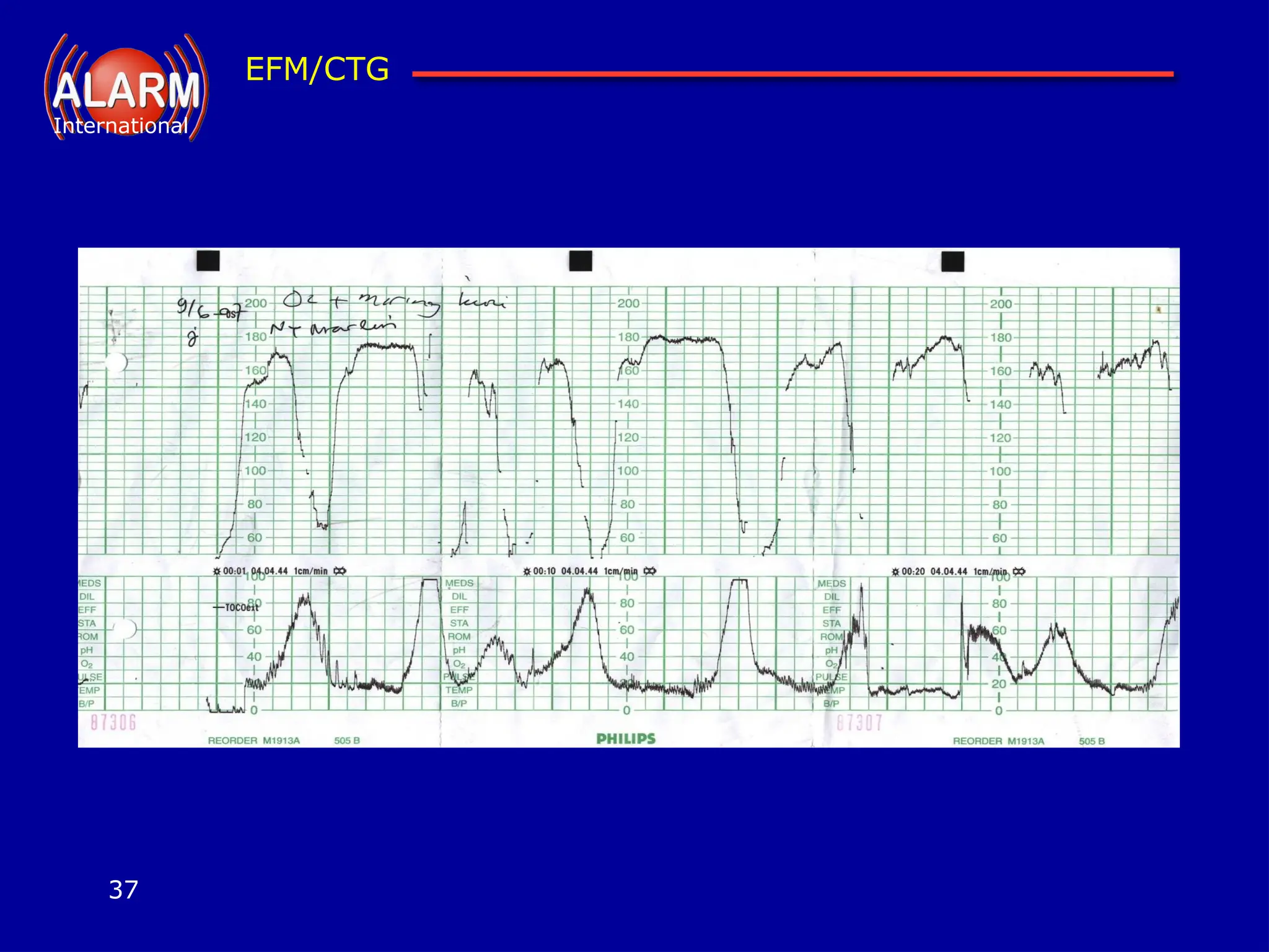 Electronic Fetal Monitoring (EFM-CTG).pptx