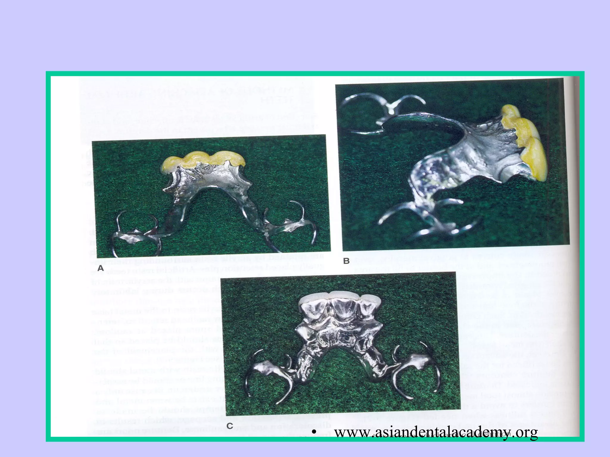 Denture base considerations in removable partial denture /RPD | PPT