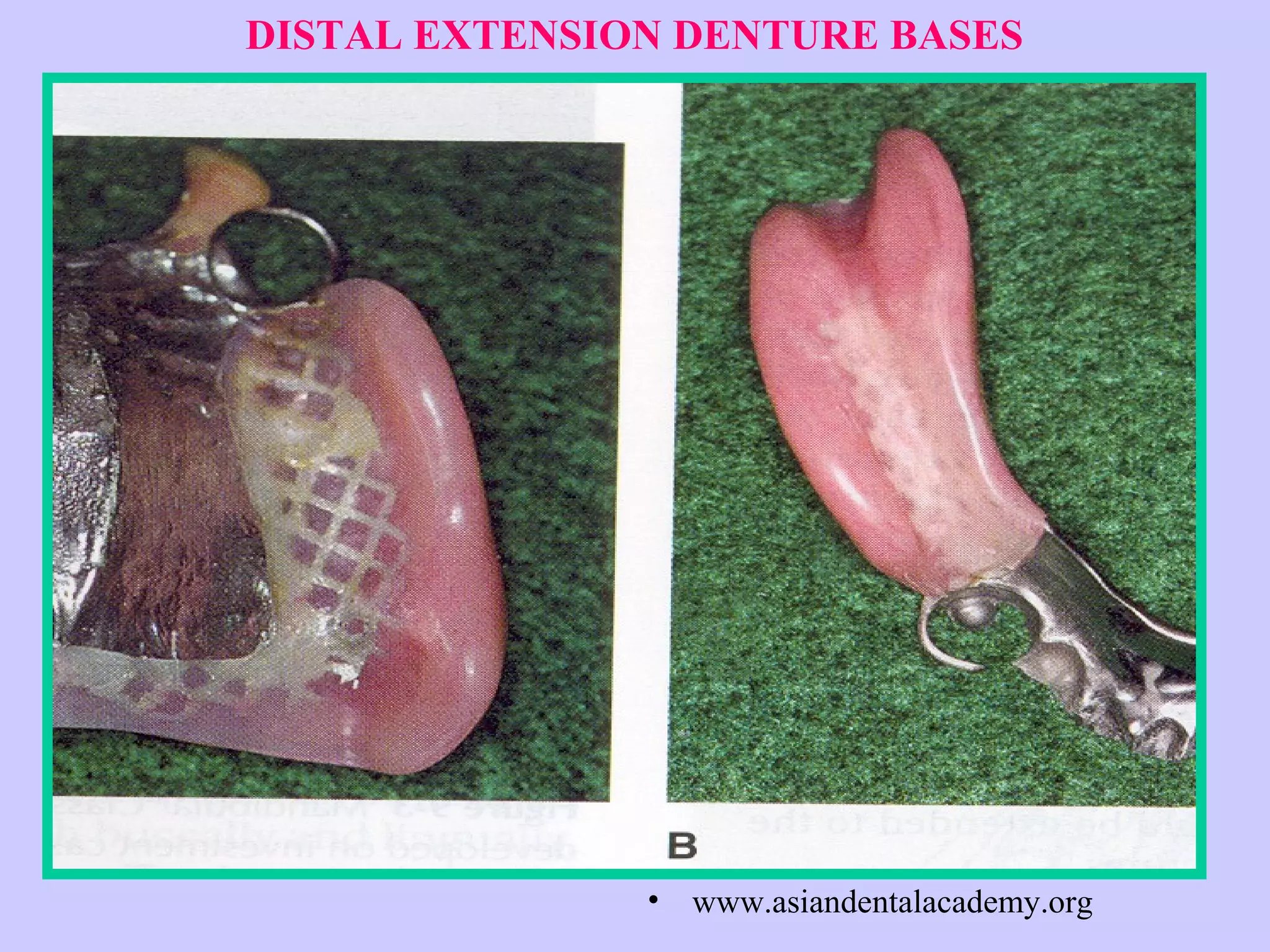 Denture base considerations in removable partial denture /RPD | PPT