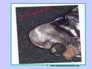 Denture base considerations in removable partial denture /RPD | PPT