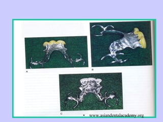 Denture base considerations in removable partial denture /RPD | PPT
