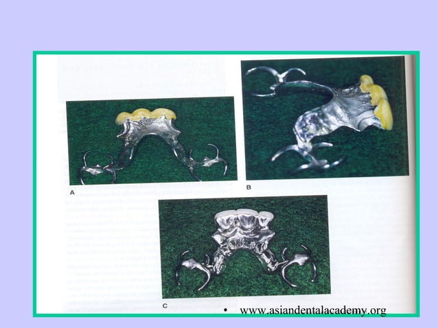 Denture base considerations in removable partial denture /RPD | PPT