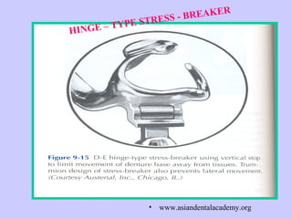 Denture base considerations in removable partial denture /RPD | PPT