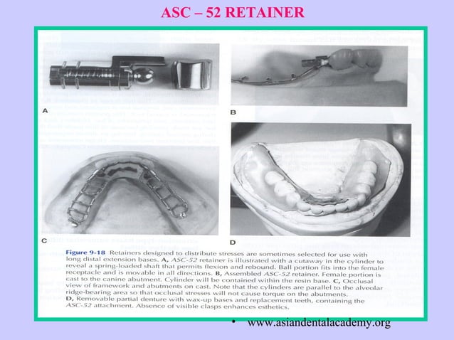 Denture base considerations in removable partial denture /RPD | PPT